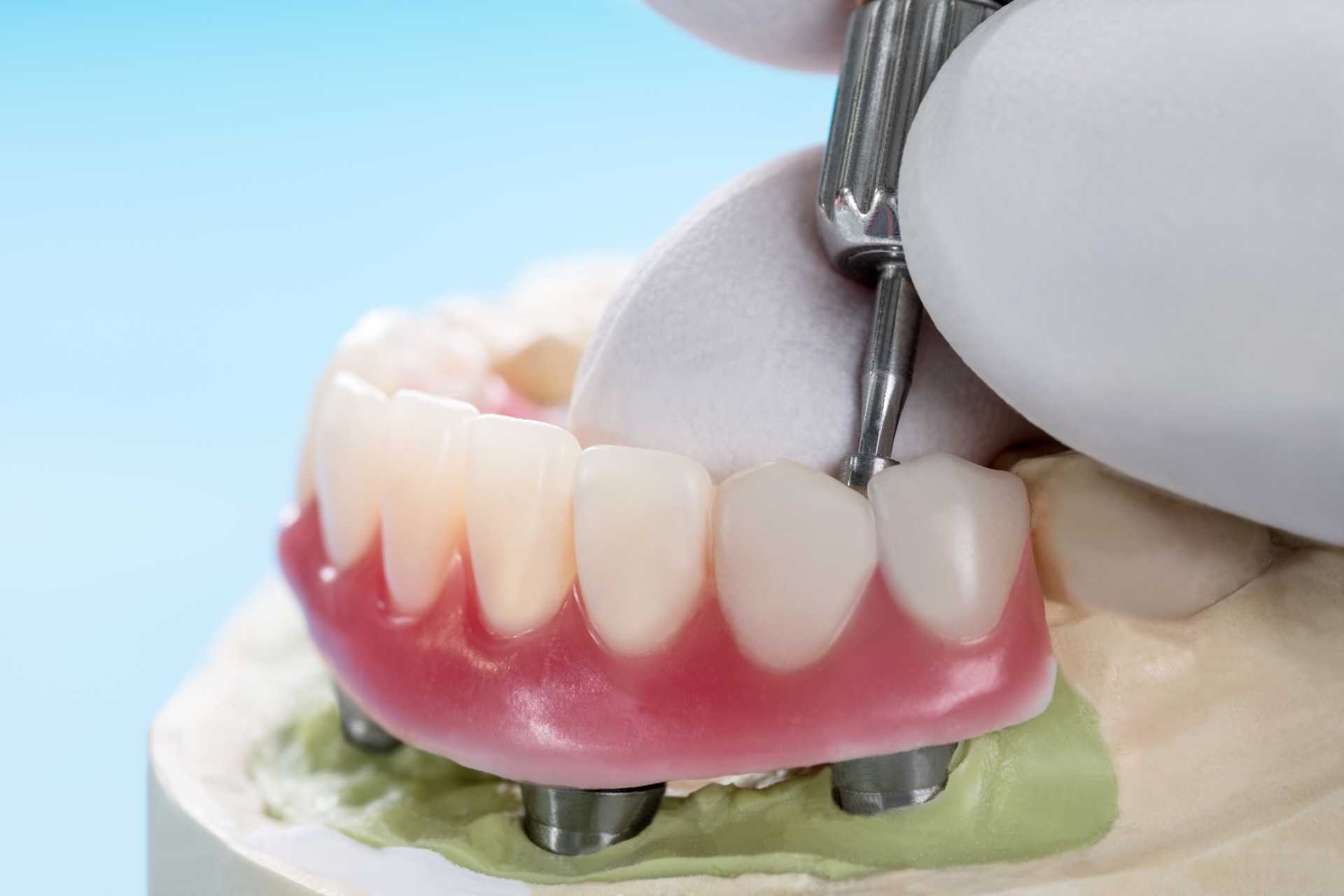 Implant overdenture: what you should know