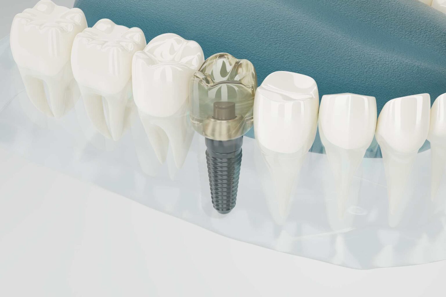 All types of dental implants well explained