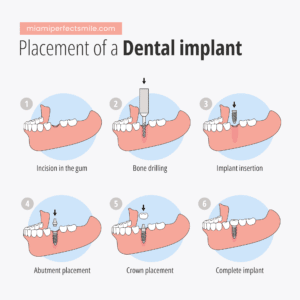 Difference between temporary and permanent dental implants