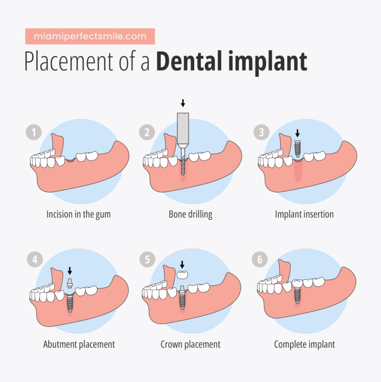 Difference between temporary and permanent dental implants