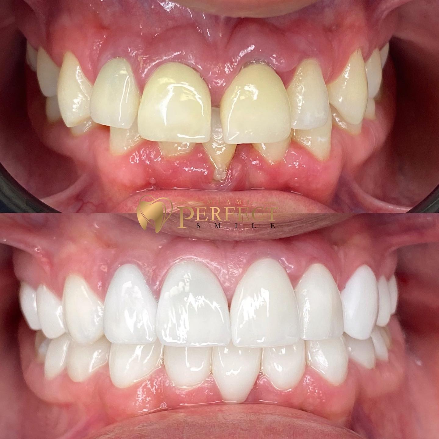 $1200 Veneer Special | Porcelain Veneers in Miami by Dr. Helen Carmenate