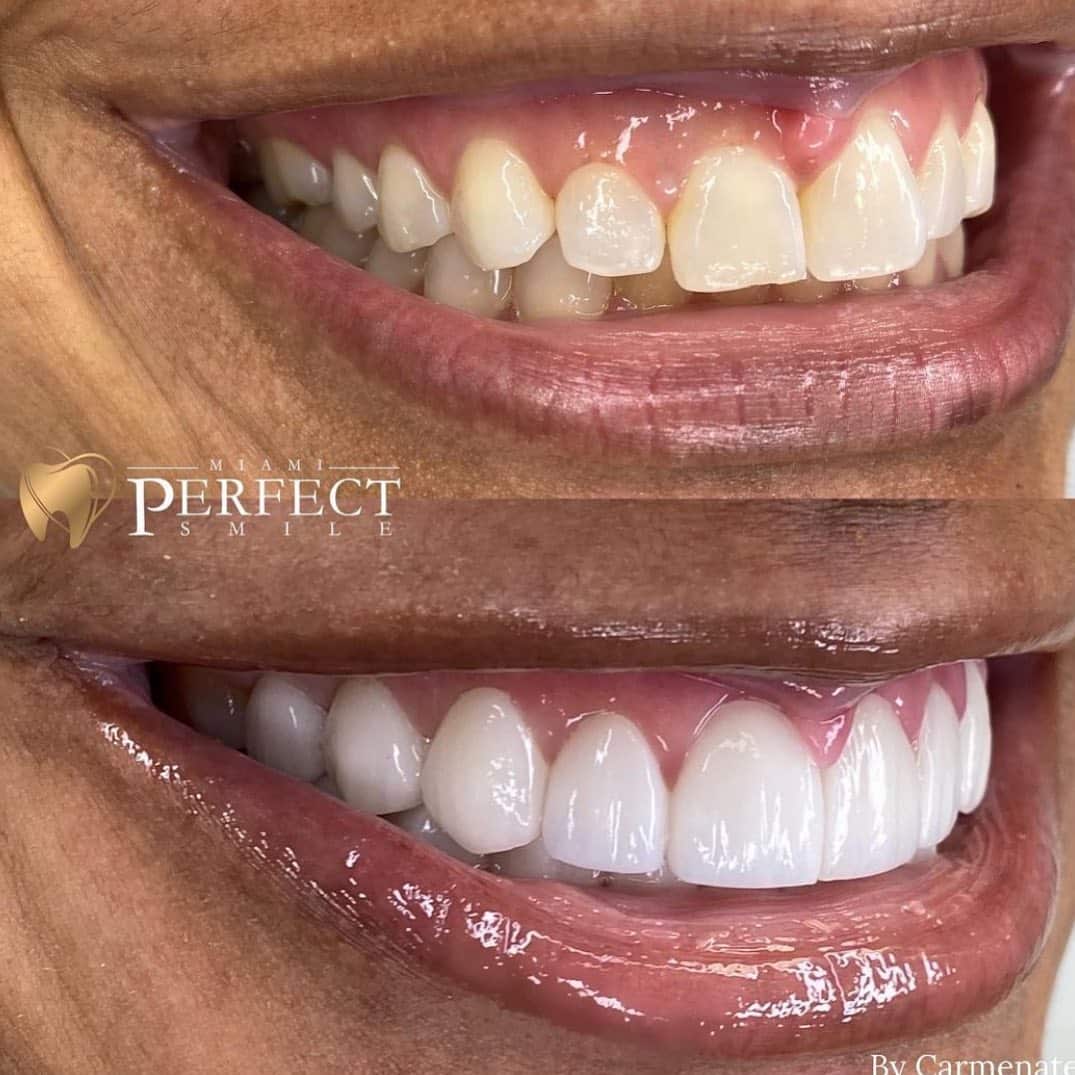 $1200 Veneer Special | Porcelain Veneers in Miami by Dr. Helen Carmenate