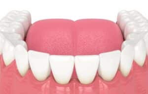 Teeth bonding service at Miami Perfect Smile
