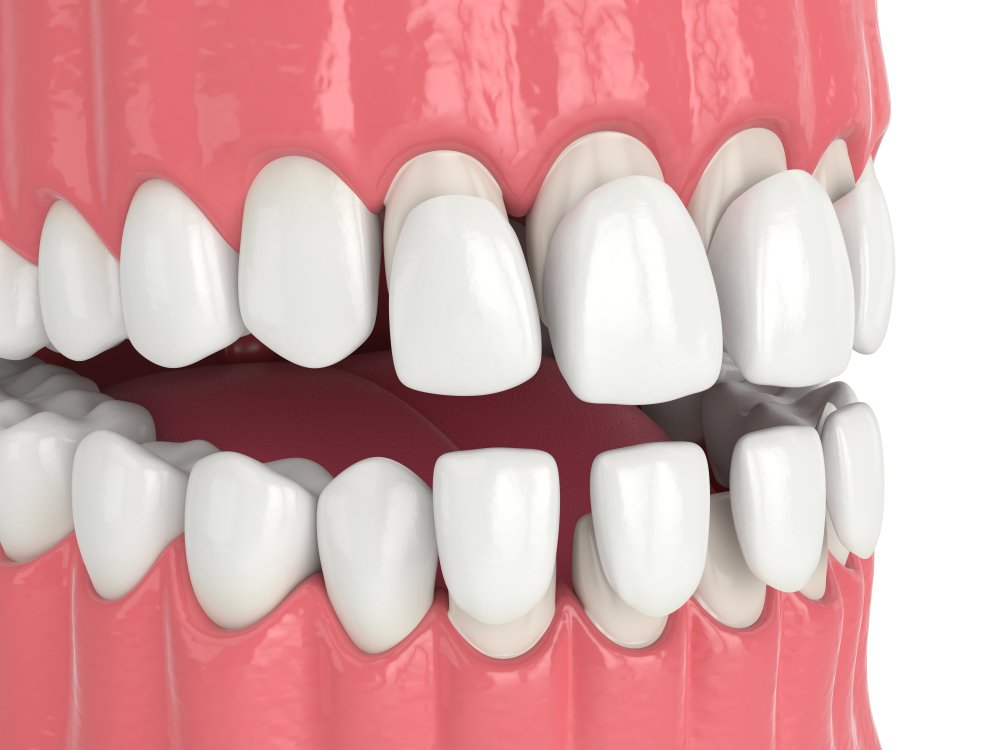Composite Resin Veneers Miami at $4500
